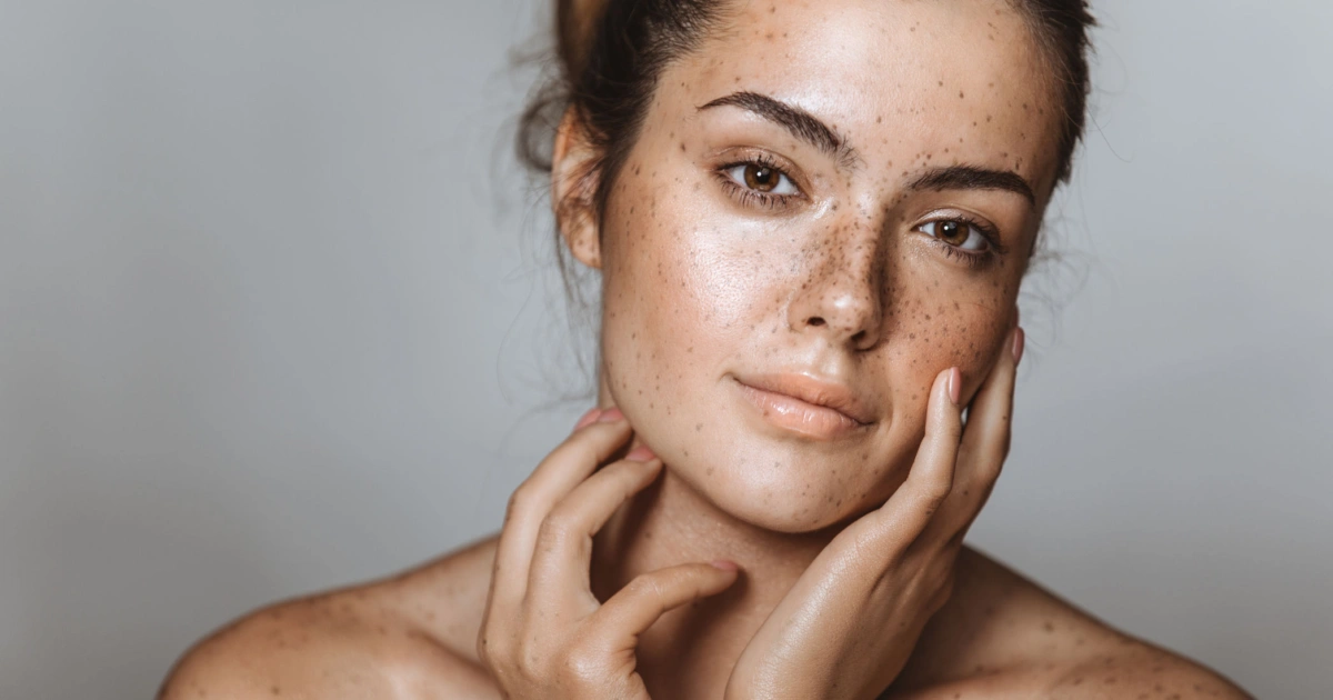 Pigmentflecken: Alles, was du über Hyperpigmentierung wissen musst